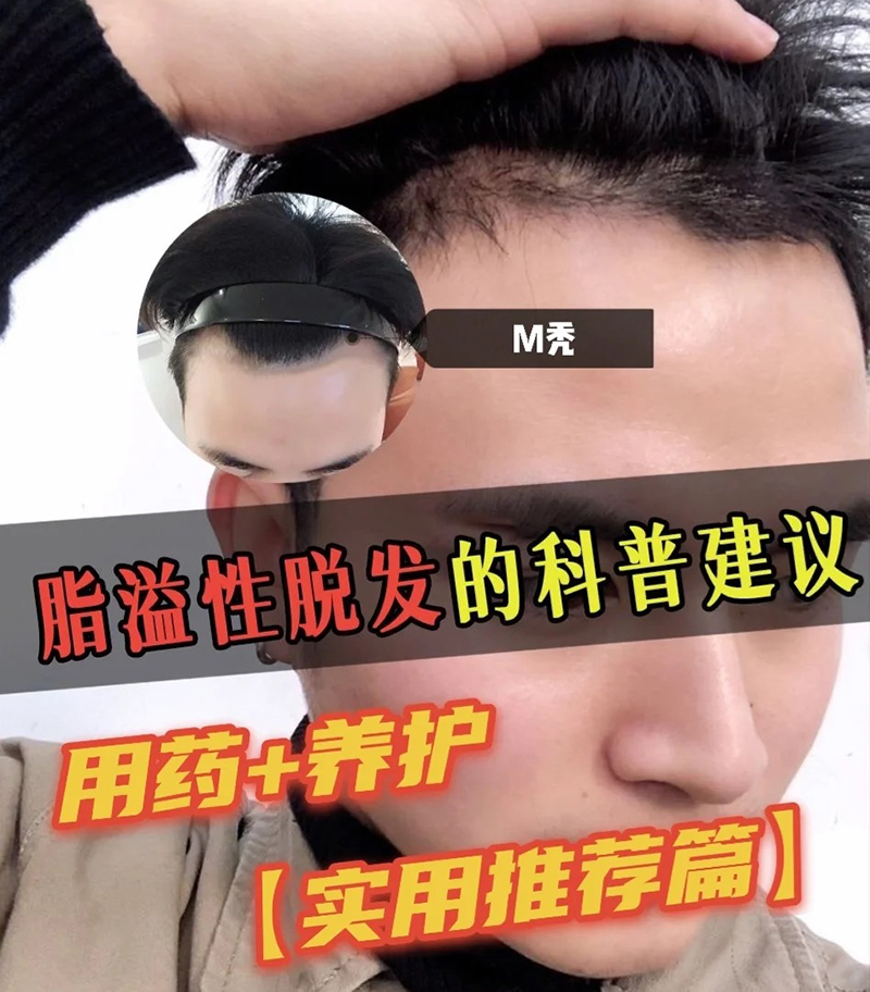 脂溢性脱发的科普建议